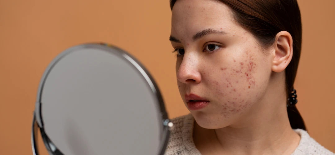Redness from Pimples and Acne: How to Get Rid of It? - Rawafed Pharma